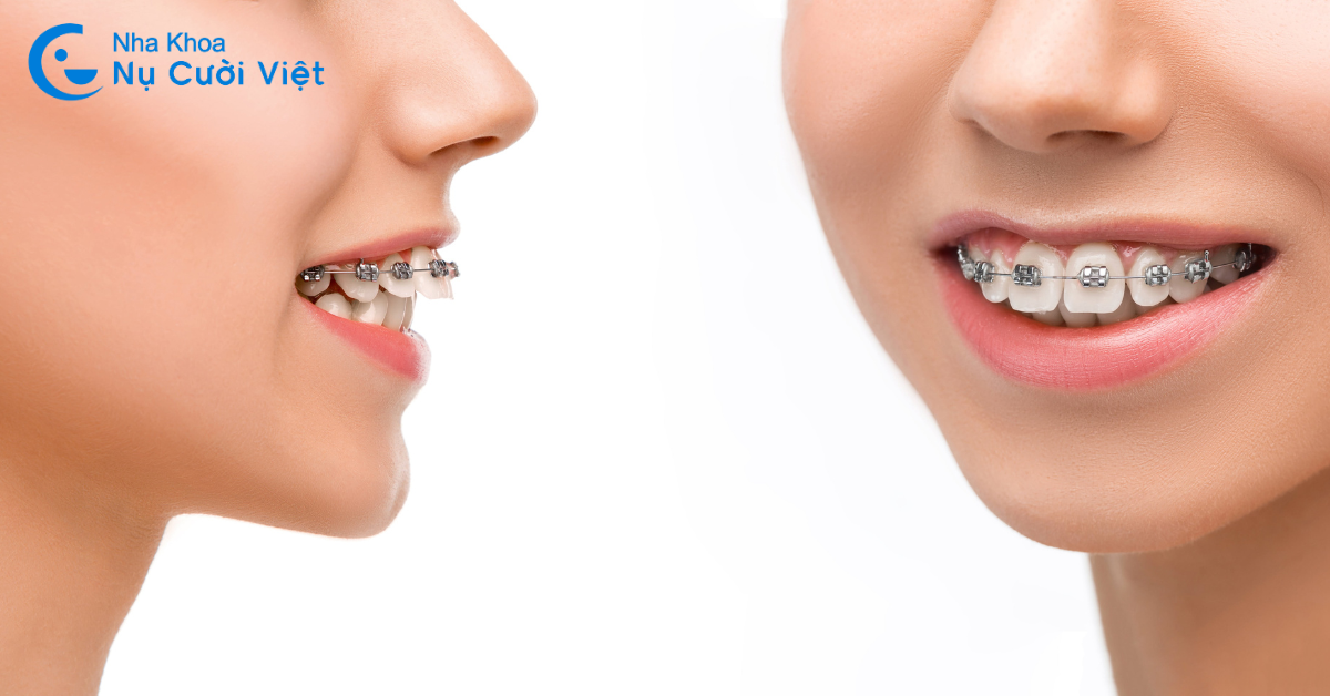 Răng hô: Nguyên nhân và phương pháp điều trị hiệu quả nhất